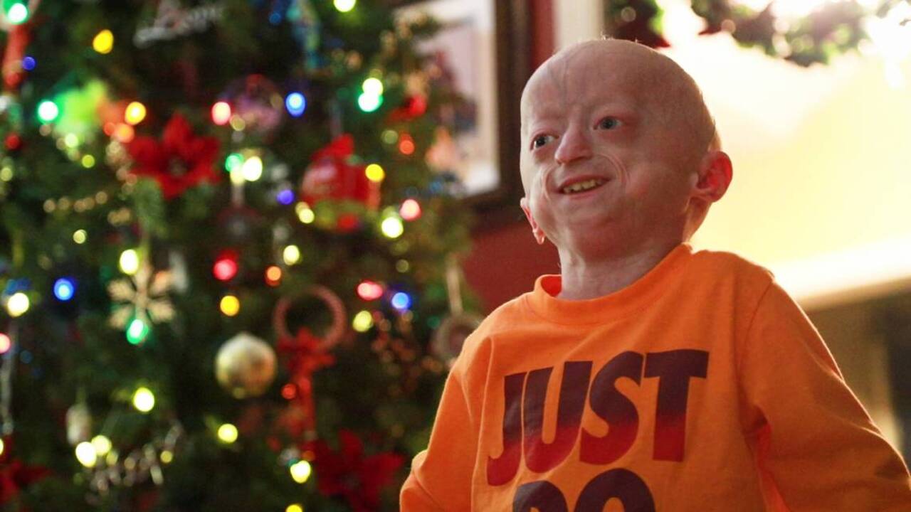 Child with progeria receives hip replacement, has new dog | Lexington ...